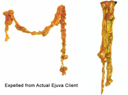 Mucoid Plaque - Ejuva- Colon Cleansing & Rejuvenation System